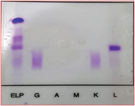 Increased Accumulation Of Lambda Light Chain In The Lambda Zone On