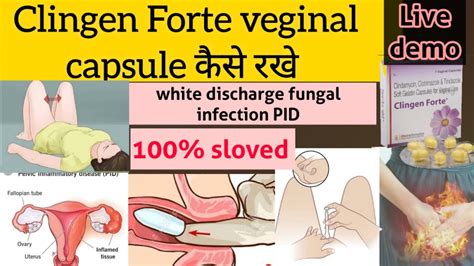 Clingen Forte Veginal Capsule Kaise Rakhe Youtube