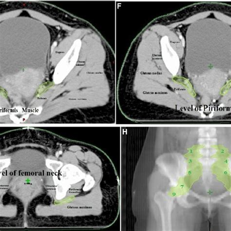 Pdf Lumbosacral Plexus Delineation Dose Distribution And Its