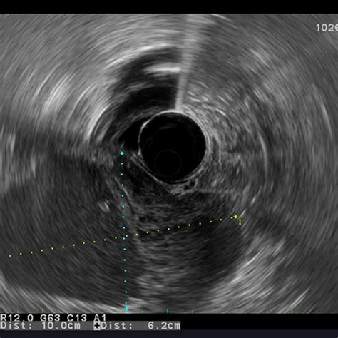 Presumptive Diagnosis Based On EUS Features Download Table