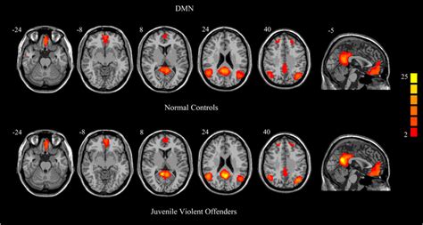 One Sample T Test Results For Group Level Dmn In Normal Controls And