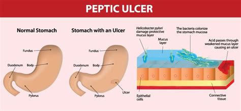 Peptic Ulcer Symptoms