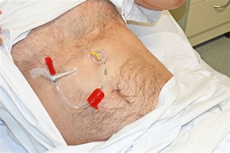 Peg Feeding Certificate A Complete Guide For Nurses ⇢