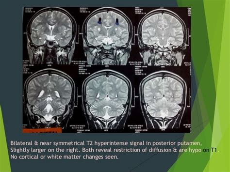 Sspe Myasthenia N Letm