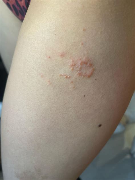 How To Treat This Ringworm Have Had It Over A Month And Wont Go Away