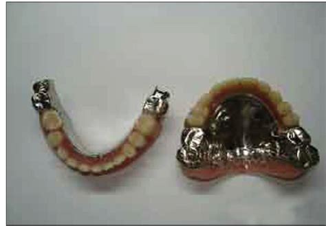 Finished Maxillary And Mandibular Fixed Removable Cast