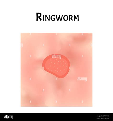 Ringworm Of The Scalp Cut Out Stock Images Pictures Alamy