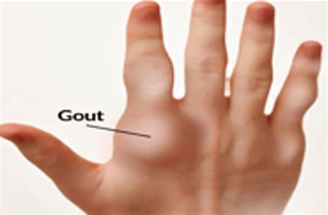 Cppd Pseudo Gout