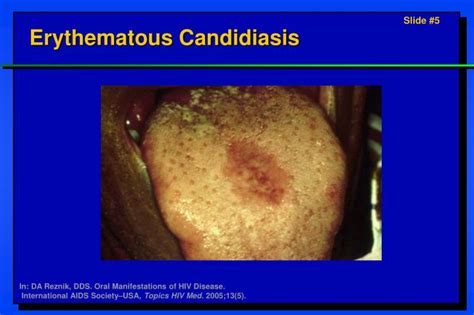 Erythematous Candidiasis Hiv