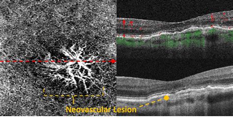 Imaging Neovascular Amd With Oct And Octa