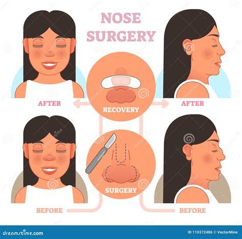 Nose Plastic Surgery Vector Illustration Stock Vector Illustration