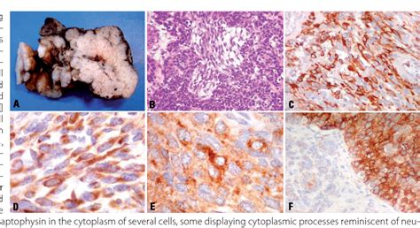 Figure 2 From Supratentorial Primitive Neuroectodermal Tumor Pnet An