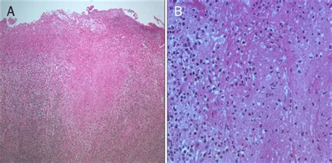 Histopathologic Findings Of The Resected Gallbladder Hande A Download Scientific Diagram