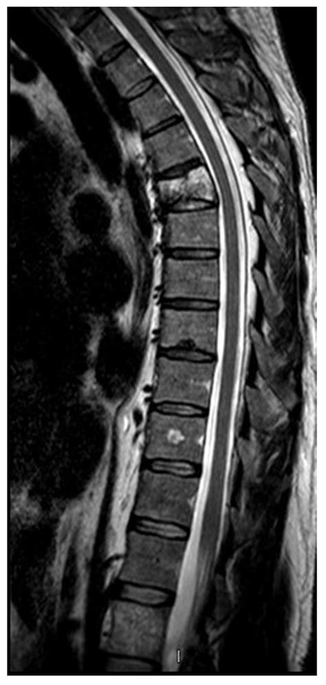 Pathological Fracture Spine
