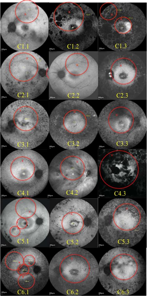 Site Of Subretinal Blebs Post Gene Therapy In All 18 Trial Download Scientific Diagram