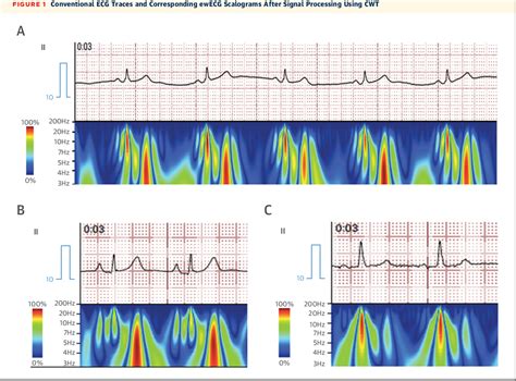 Figure 1 From Machine Learning Of Ecg Waveforms To Improve Selection For Testing For