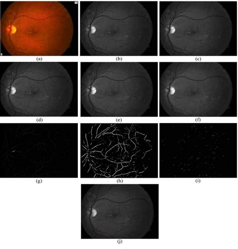 Figure 2 From Automatic Detection Of Microaneurysms In Rgb Retinal Fundus Images Semantic Scholar