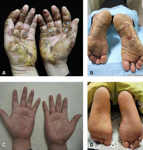 Clinical Improvement Of Patients After 6 Weeks Of Dupilumab Treatment