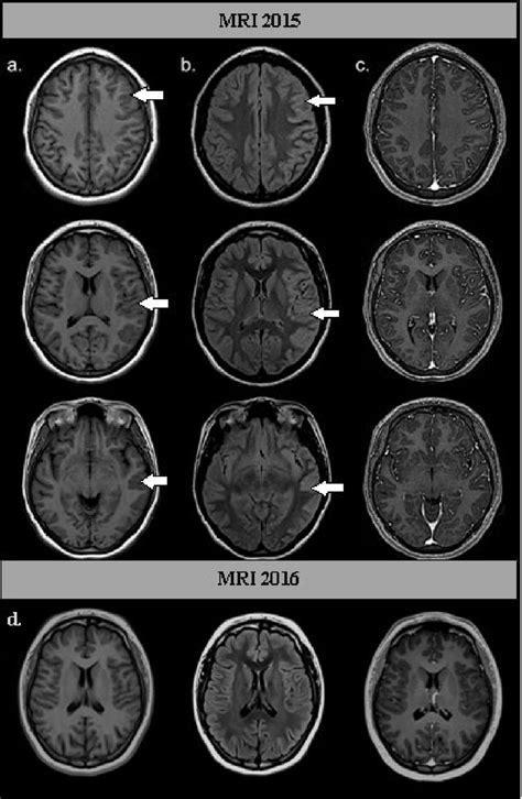 Comparison Of The Patients Mri Done In 2015 A To C Versus A Download Scientific Diagram