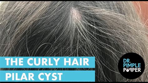 Epidermoid Cyst Scalp