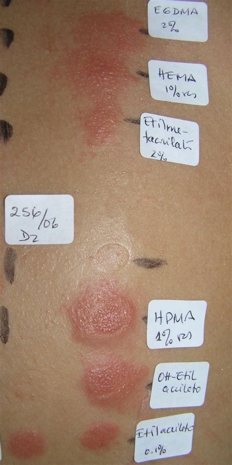 Multiple Intense Positive Patch Tests To Several Acrylates Ethyl And Download Scientific