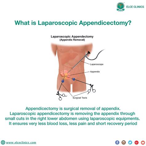 Elce What Is Laparoscopic Appendicectomy Facebook