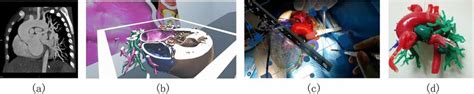 Illustration Of 3d Virtualization And 3d Printing In Chd Surgery A