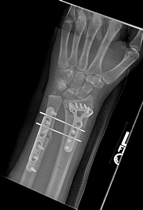 Bilateral Forearm Orif Expert Hand Surgeons In The East Bay