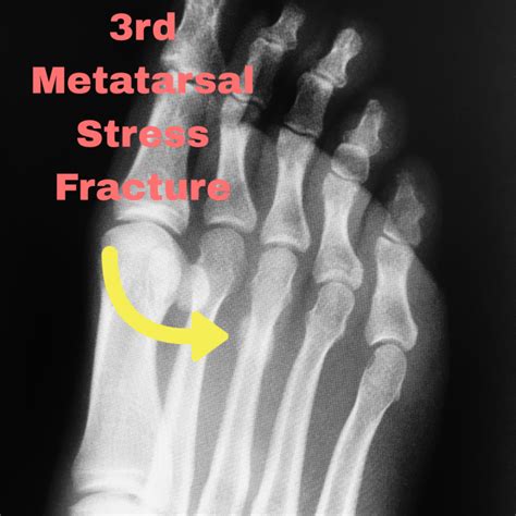 Metatarsal Stress Fractures Final Kick Ankle And Foot Clinic Ankle