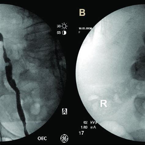 Right Retrograde Pyelogram Revealing Multifocal Filling Defects Within