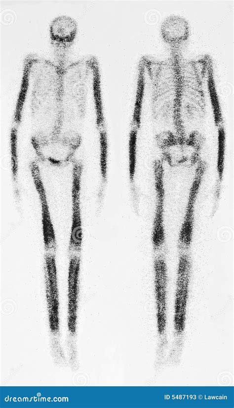 CT Scan Of Fractures Cervical Spines Royalty Free Stock Photo CartoonDealer Com 154760973