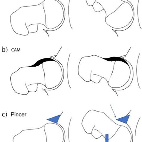 MR Arthrogram Showing A Labral Tear With Chondrolabral Disruption Download Scientific Diagram
