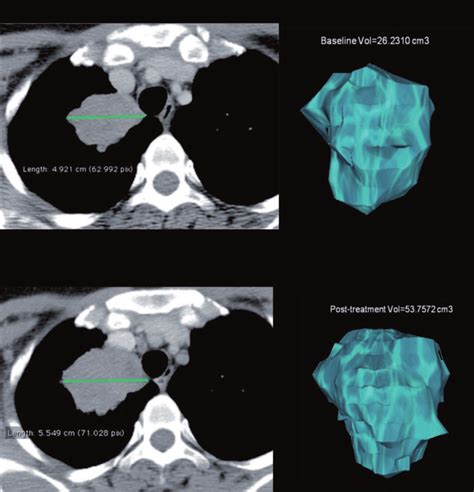 Volumetric Assessment Of A Lung Mass A Computed Tomography Ct And Download Scientific