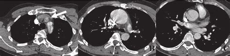 Computed Tomography Ct Angiography A Revealed An Intimal Flap In The