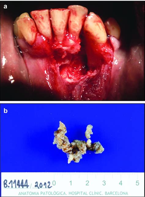 Macroscopic Appearance A Intraoperative Image Typical Infrabony Download Scientific Diagram
