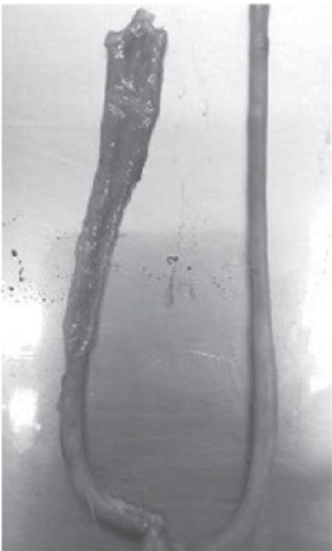 Redness And Thin Mucosal Of Duodenum Download Scientific Diagram