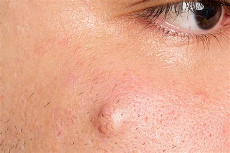 Foto Penyebab Kista Epidermoid Dan Kapan Harus Ke Dokter