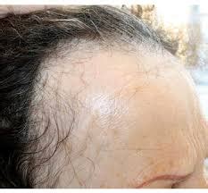Understanding Fibrosing Alopecia Anthony Pearce Trichology