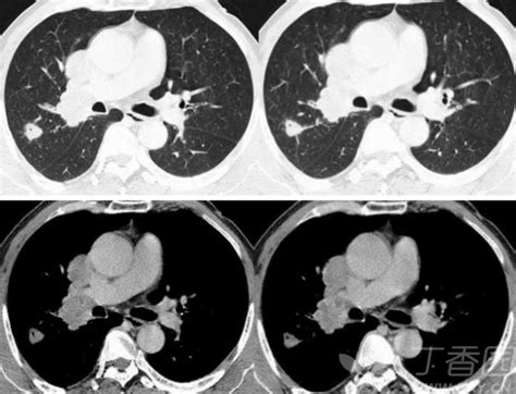 详细解说“支气管充气征” Medsci Cn