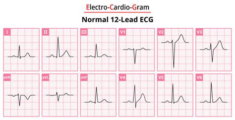 Electrocardiograma Normal