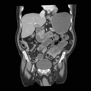 Ct Of The Abdomen And Pelvis Showing Evidence Of Small Bowel Download Scientific Diagram