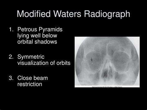 Ppt Radiography Of The Orbits Powerpoint Presentation Free Download