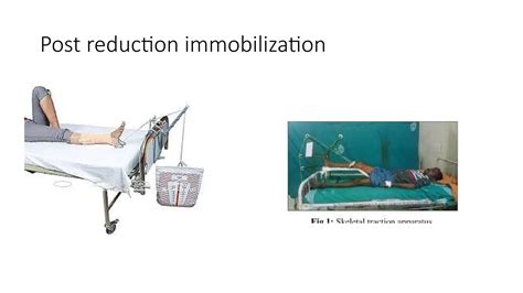 Management Of Shoulder And Hip Dislocation Pptx