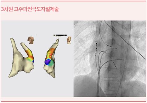 조기수축 기외수축 형 부정맥 심방조기수축 심실조기수축 네이버 블로그