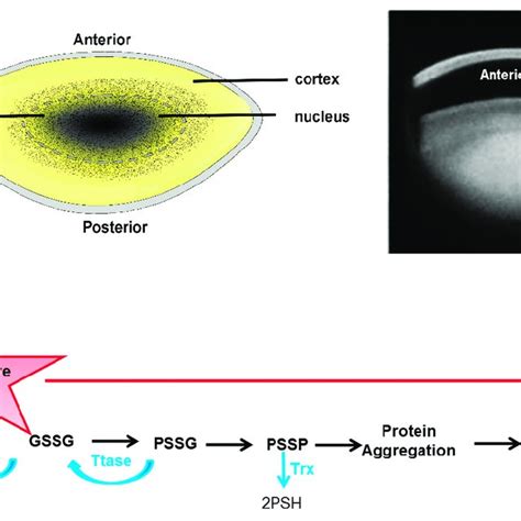 Nuclear Cataracts A Location Of The Nuclear Cataract Subtype Left Download Scientific