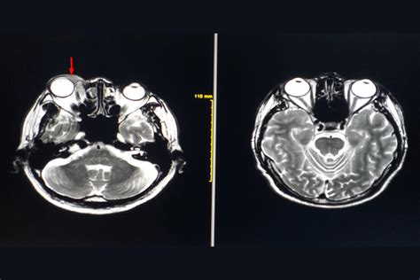 Orbital Tumors Danbury Orbital Disease And Surgery Danbury Ct