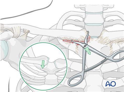 Reduction Of Sternoclavicular Dislocation For Medial Articular Clavicle Fracture