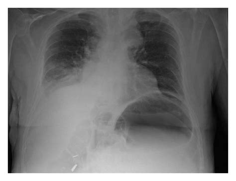 X Ray Chest And Abdomen Showing Opacification In The Left Hypochondrium Download Scientific