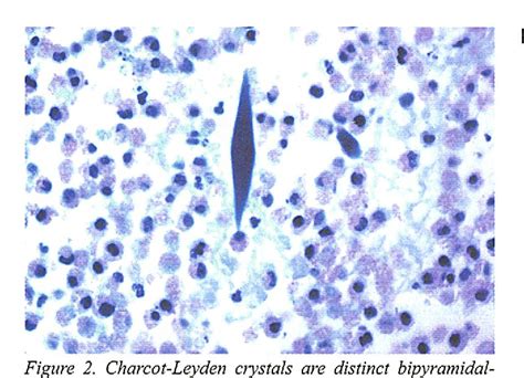 Figure 3 From Charcot Leyden Crystals Pathology And Diagnostic Utility Semantic Scholar