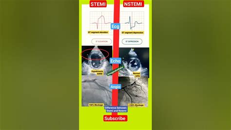 Difference Between Stemi Heart Attack 💔 And Nstemi By Ecg Echo Angiography Echo Shorts